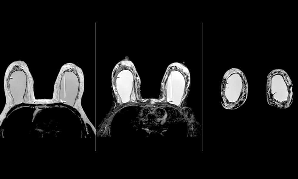 La resonancia magnética mamaria permite seleccionar pacientes que ... La resonancia magnética mamaria permite seleccionar pacientes que ...
